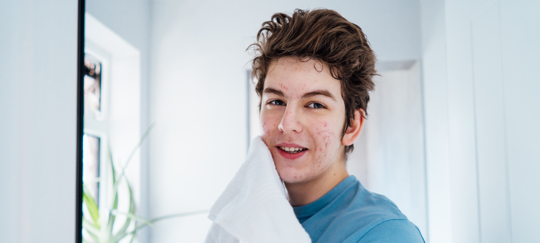 Improving acne treatments - Be Part of Research